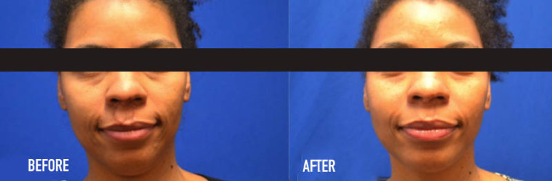 Upper Lip Scar Microneedling Treatment - Celestial Plastic ...